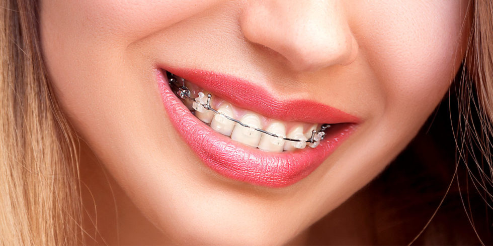 Types of Braces - Epps Orthodontics